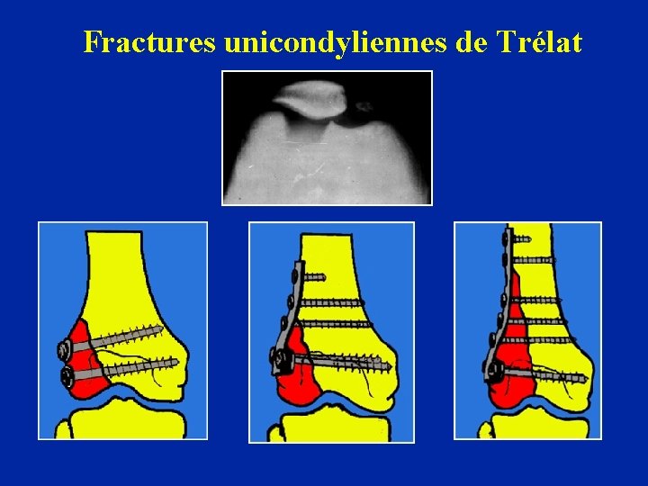 Les traumatismes osseux du genou DR BELAID SERVICE