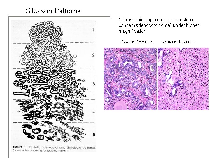 Prostate Needle Biopsy The Pitfalls and the Role