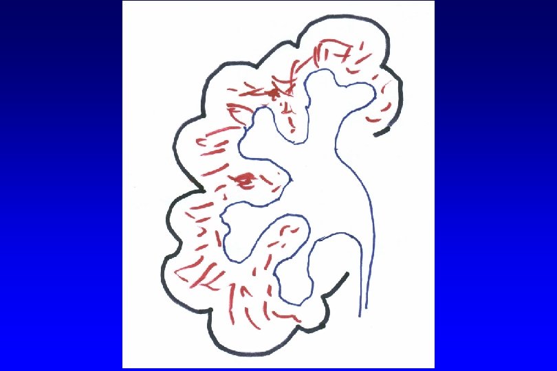 Pyelonephritis Hgyti infekcik Dr de Chtel Rudolf Semmelweis