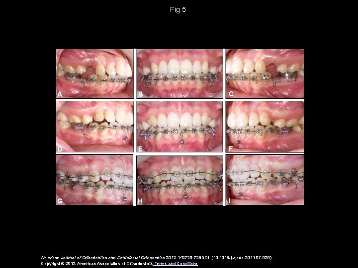 Threedimensional retraction of anterior teeth with orthodontic miniplates