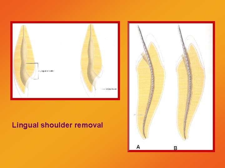 A lingual surface of all anterior teeth B