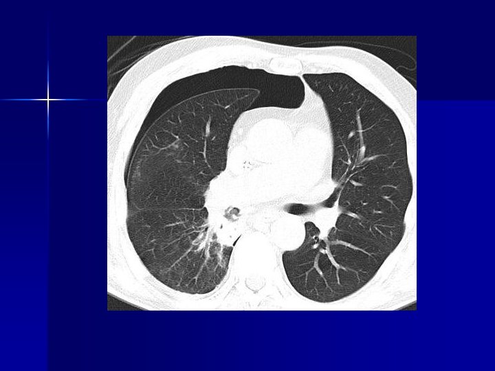Pneumothorax Prise en charge en urgence PLAN Pr