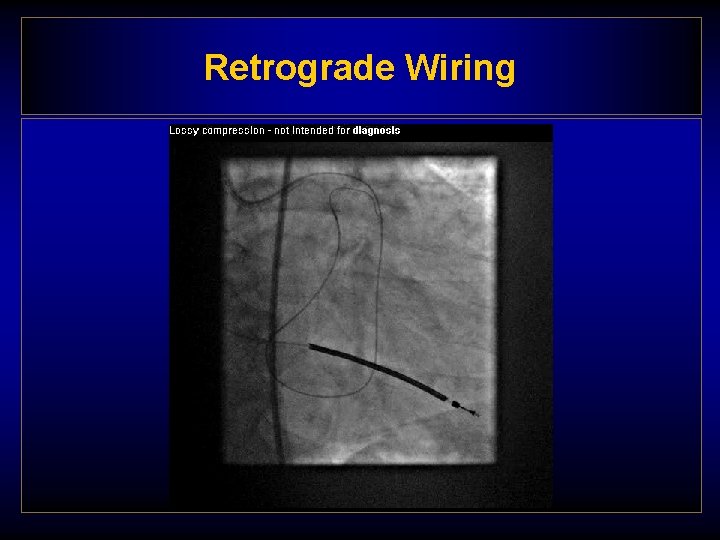 Guidewire strategy for antegrade and retrograde lesion crossing