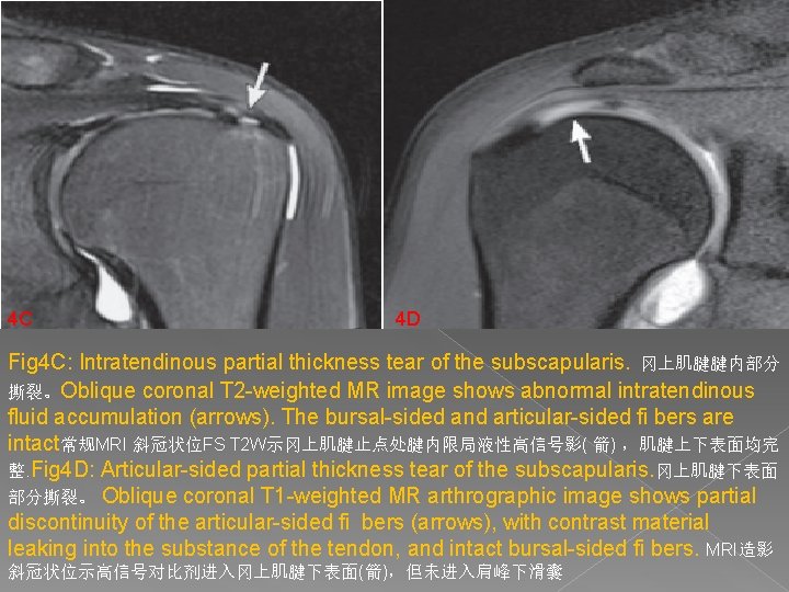 MR imaging of the common shoulder abnormalities MRI