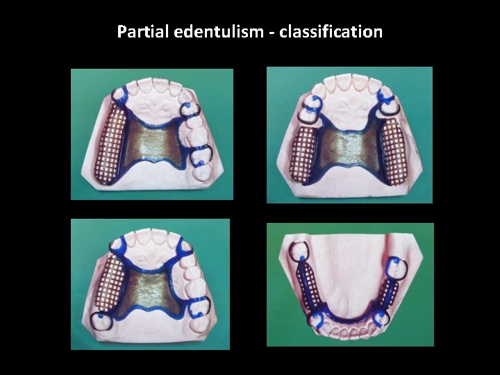 Removable Partial Dentures Prof Dr Bozhidar Yordanov Classification