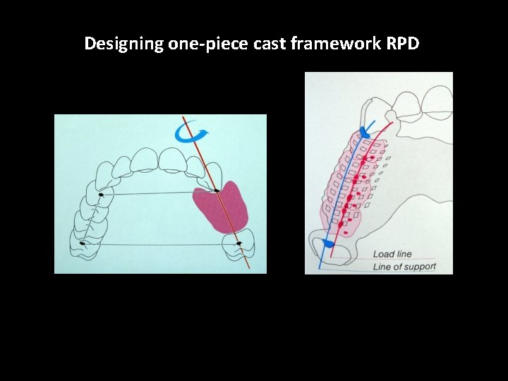 Removable Partial Dentures Prof Dr Bozhidar Yordanov Classification
