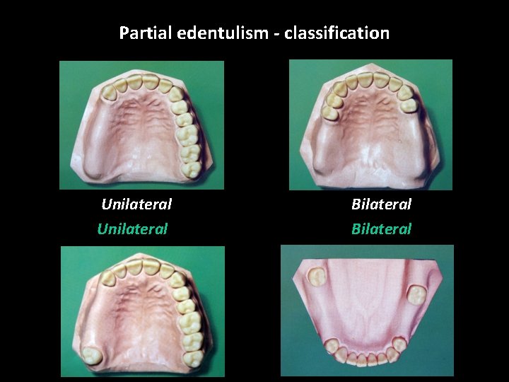 Removable Partial Dentures Prof Dr Bozhidar Yordanov Classification