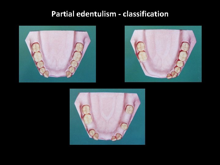 Removable Partial Dentures Prof Dr Bozhidar Yordanov Classification