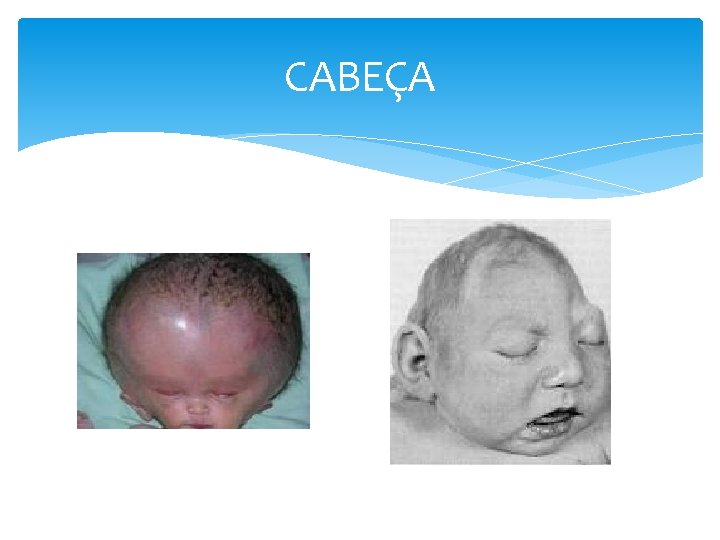 CABEA E PESCOO EXAME FSICO CABEA Tamanho Macrocefalia