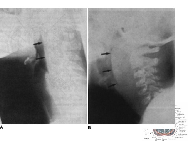 Upper Respiratory Tract Infection URTI Dr fawzia Alotaibi