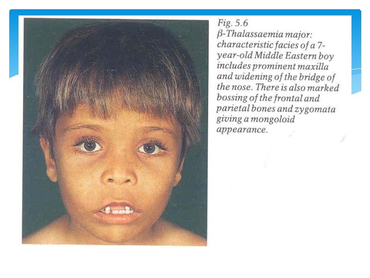 Mediterranean Anemia Thalassemia Kakavoulis Nikolaos Patras Ioannis What