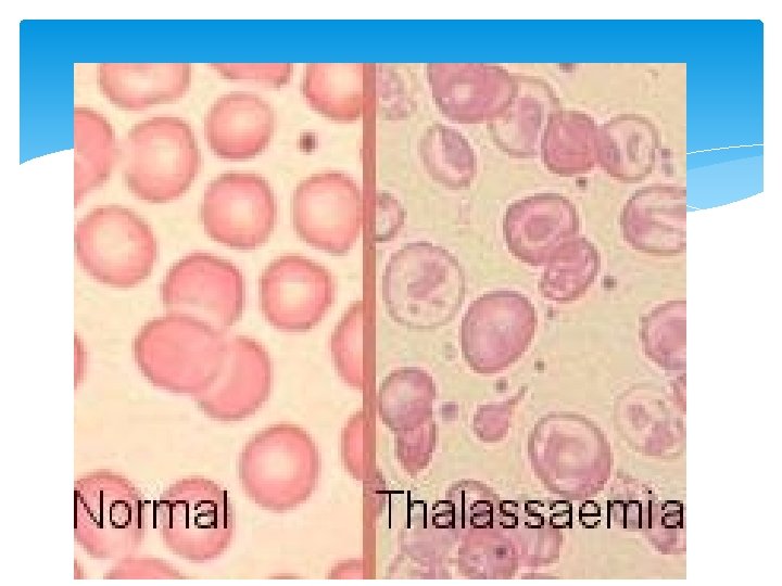Mediterranean Anemia Thalassemia Kakavoulis Nikolaos Patras Ioannis What