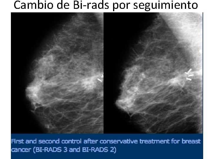 Sistema Birads para la deteccin de lesiones mamarias