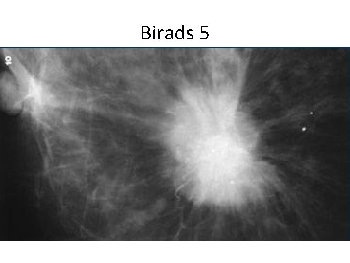 Sistema Birads para la deteccin de lesiones mamarias