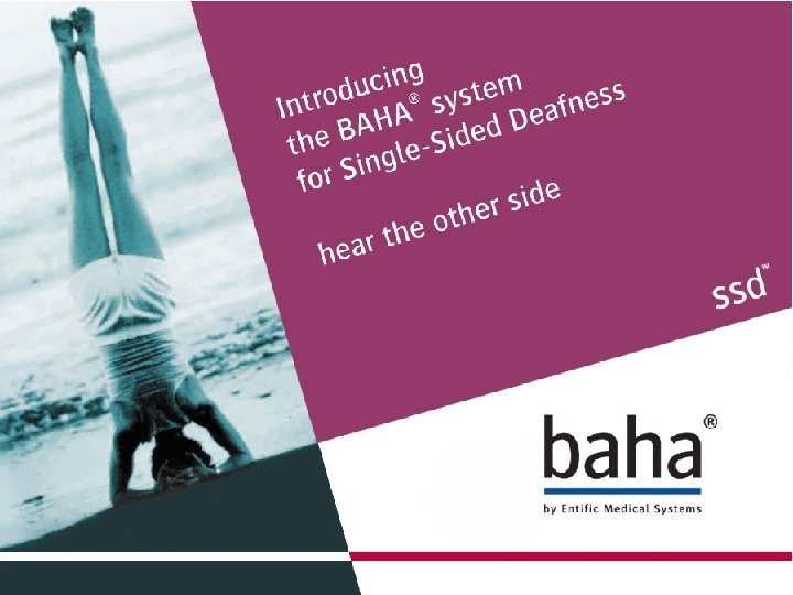The BAHA System Types of hearing loss the