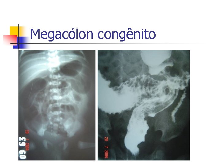 Abdome agudo Manejo da obstruo intestinal Reunio mensal
