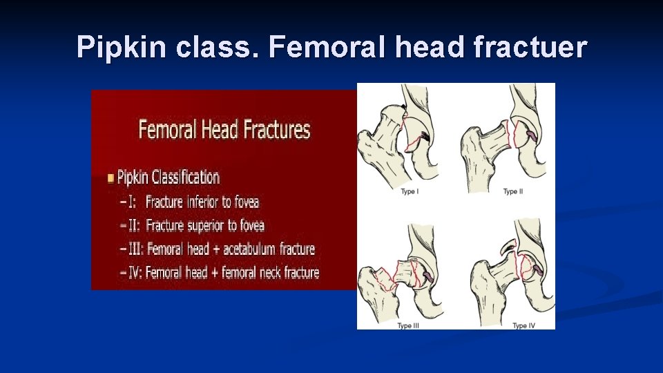 Pipkin class Femoral head fractuer Fracture neck of