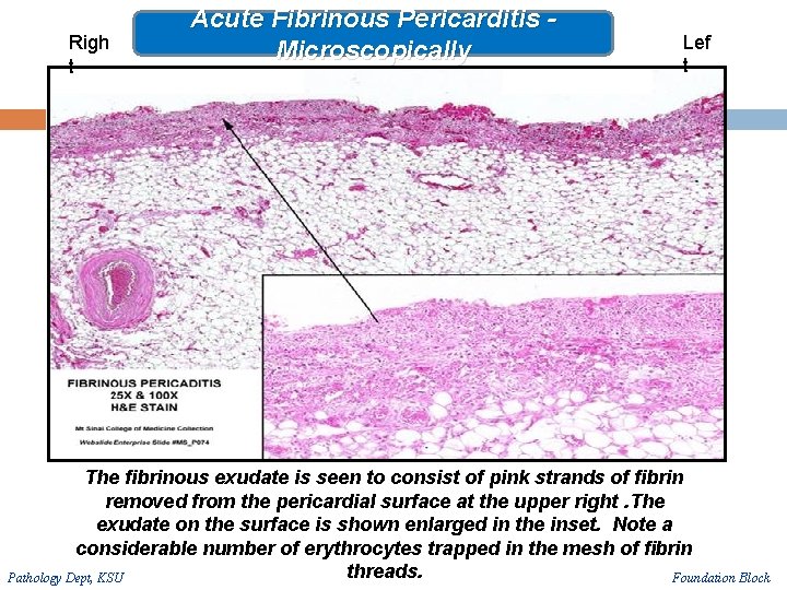 PRACTICAL 2 CELL INJURY INFLAMMATION II I Acute