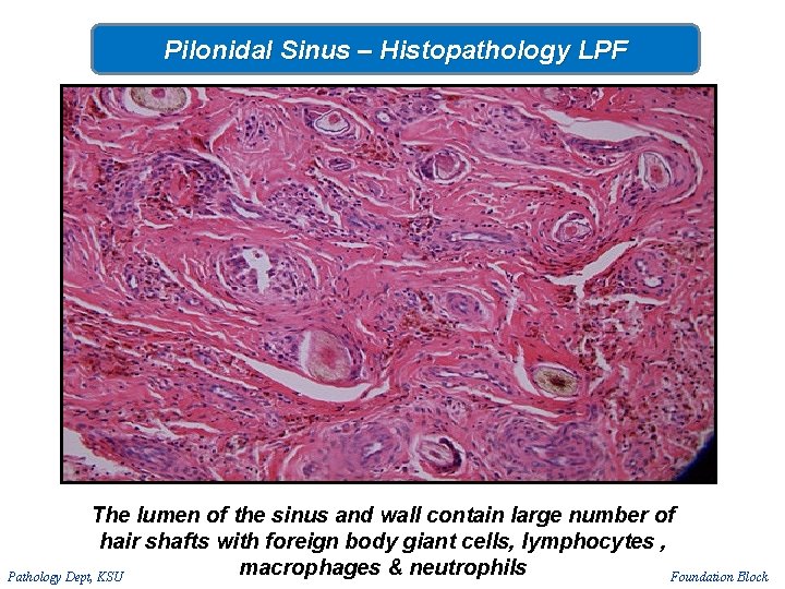 PRACTICAL 2 CELL INJURY INFLAMMATION II I Acute