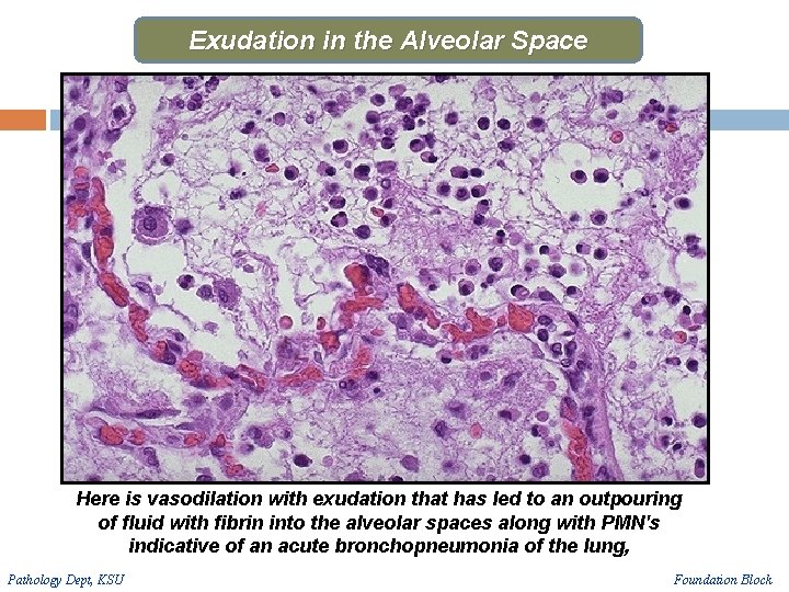 PRACTICAL 2 CELL INJURY INFLAMMATION II I Acute