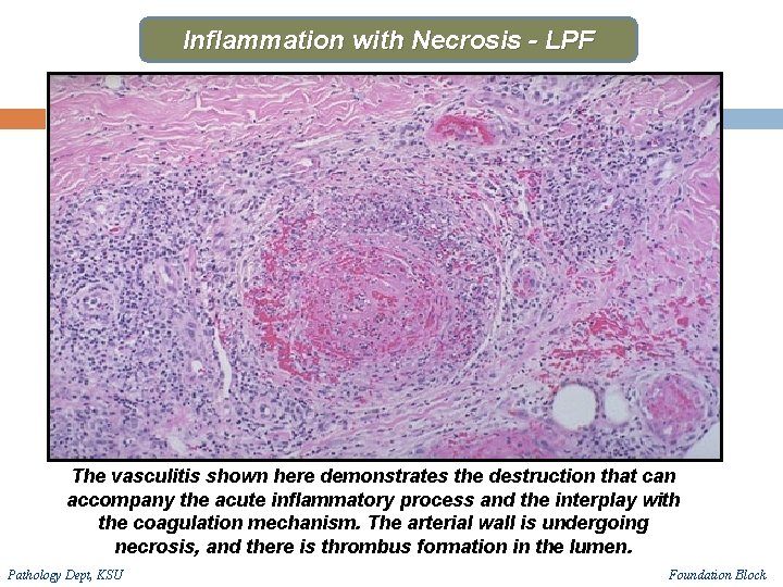 PRACTICAL 2 CELL INJURY INFLAMMATION II I Acute