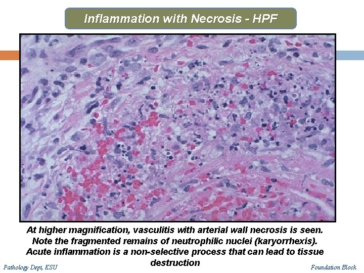 PRACTICAL 2 CELL INJURY INFLAMMATION II I Acute