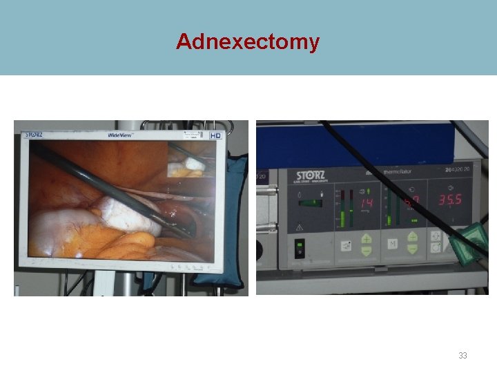 Measuring abdominal compliance for laparoscopic procedures Jan Mulier