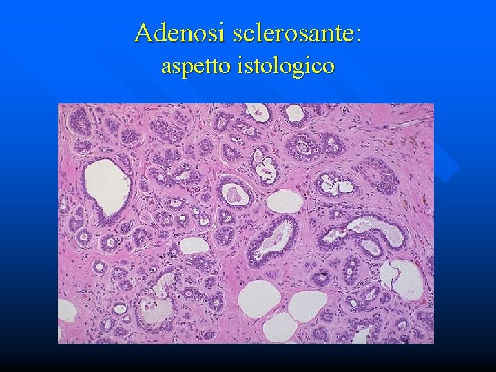 Patologia della mammella Patologia benigna Malattia fibrocistica 30