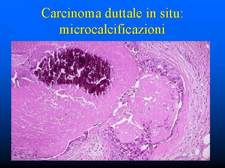 Patologia della mammella Patologia benigna Malattia fibrocistica 30