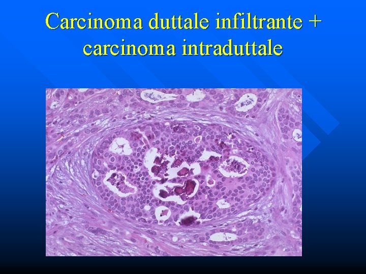 Patologia della mammella Patologia benigna Malattia fibrocistica 30