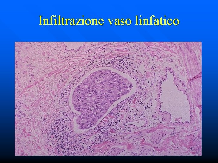 Patologia della mammella Patologia benigna Malattia fibrocistica 30