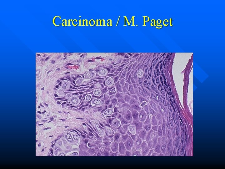 Patologia della mammella Patologia benigna Malattia fibrocistica 30