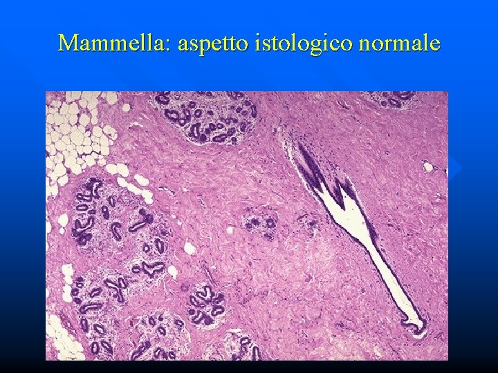 Patologia della mammella Patologia benigna Malattia fibrocistica 30