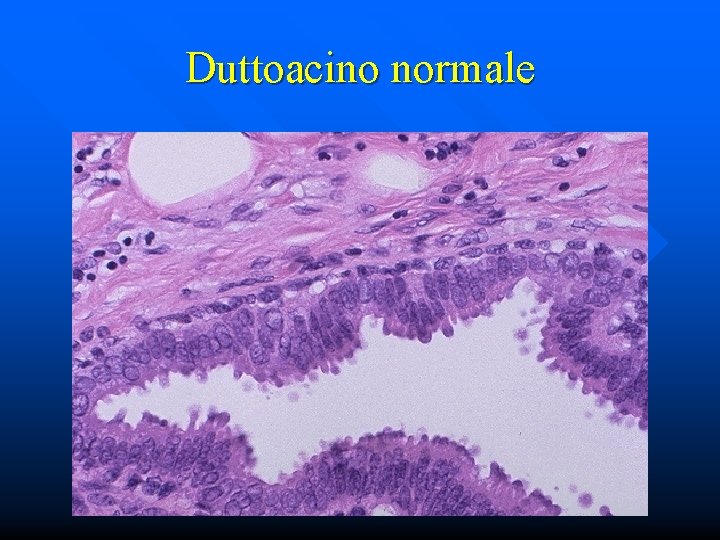 Patologia della mammella Patologia benigna Malattia fibrocistica 30