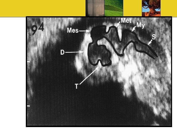 Fetal Brain Anomalies Part III Holoprosencephaly HPE Severe