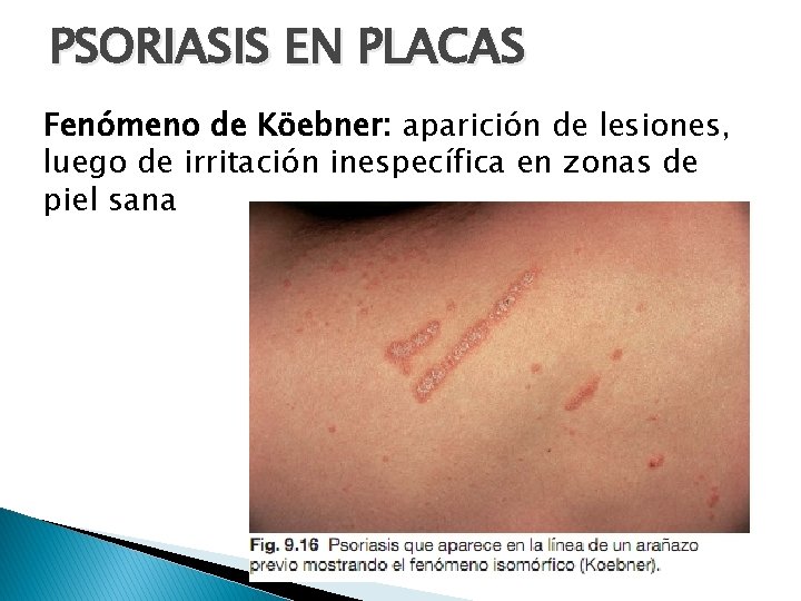 PSORIASIS CECILIA M ROMANO CLINICA PEDIATRICA MARZO 2015