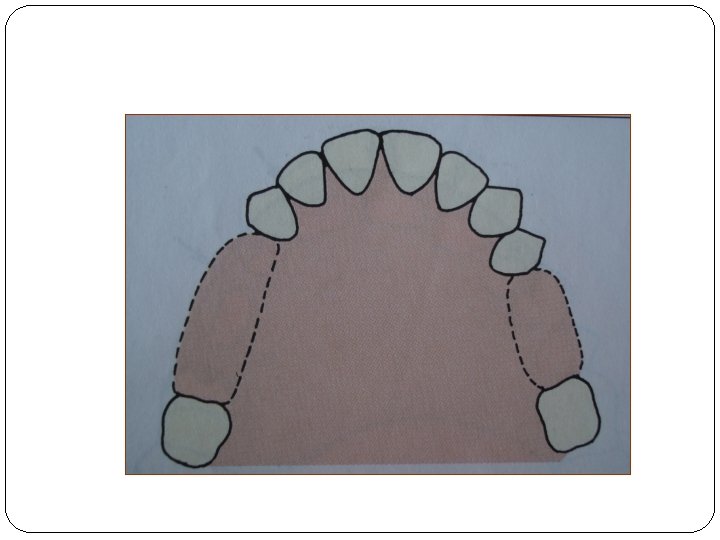 Classification of partially edentulous arches REQUIREMENTS OF AN