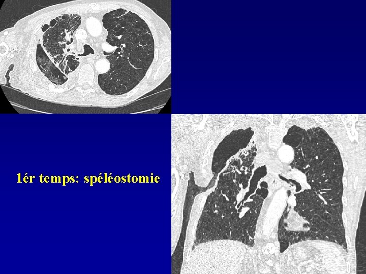 LAspergillus en pneumologie Rodica MANEA Pneumologue Centre mdical