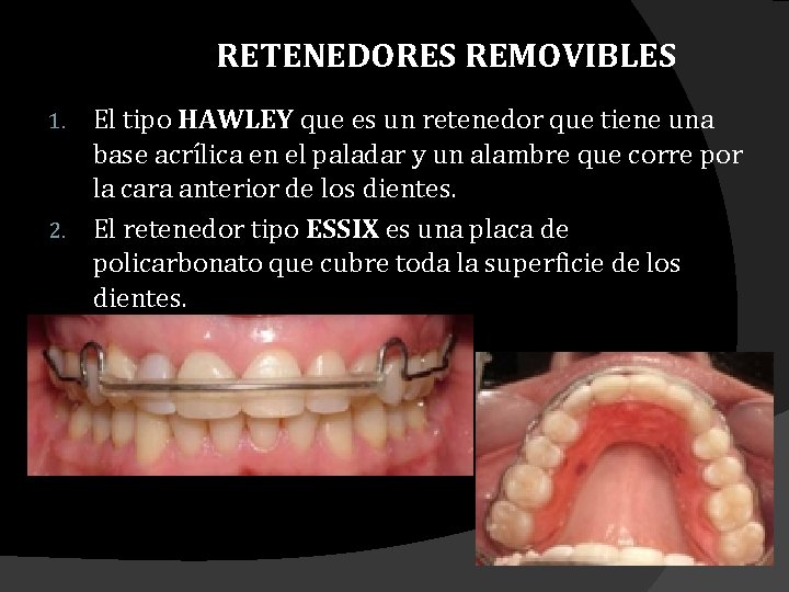 RETENEDORES EN ORTODONCIA RETENEDORES A medida que los