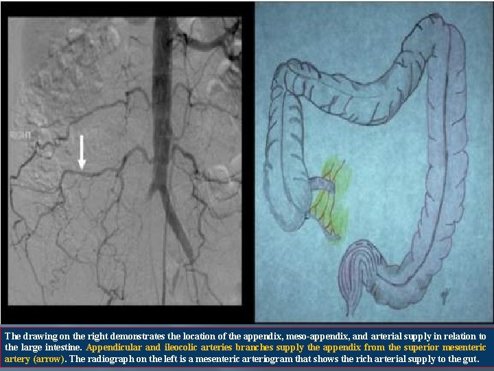 BengeziAlFallouji Predictive Score of Acute Appendicitis The New