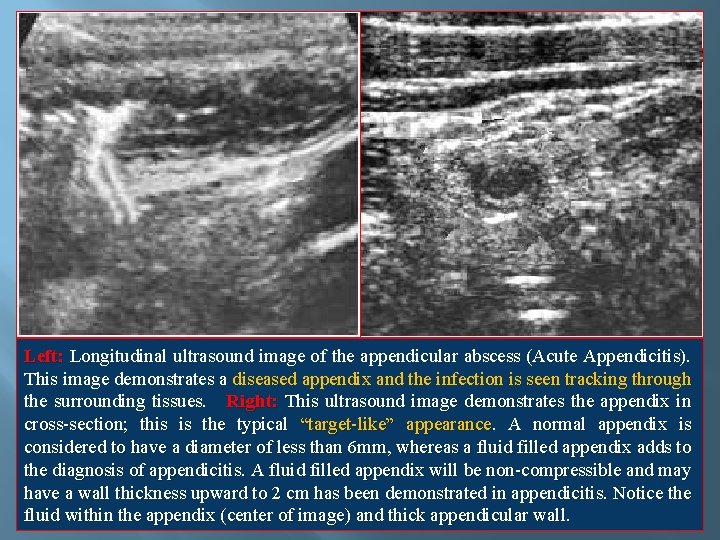 BengeziAlFallouji Predictive Score of Acute Appendicitis The New