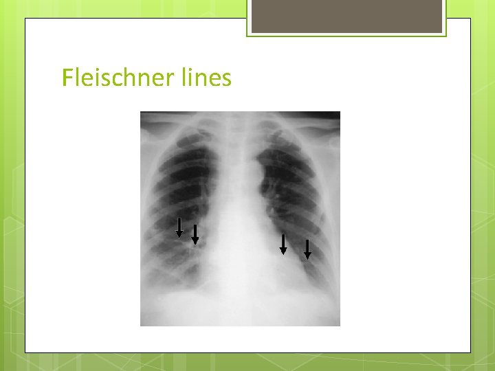 Pulmonary Thromboembolism Imaging approach OB consideration By N