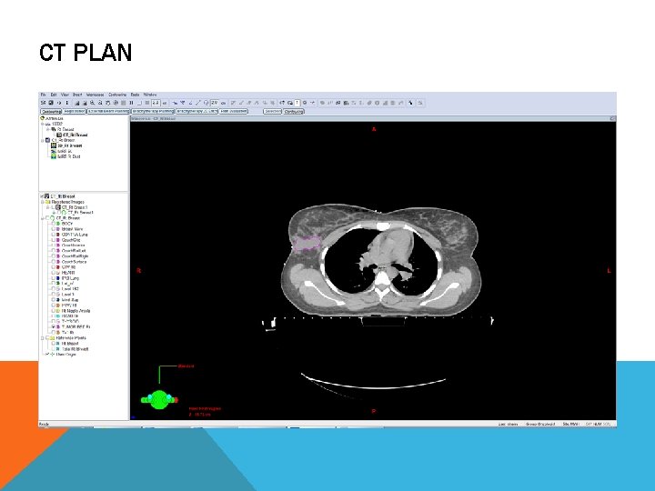 BREAST MRI IN RADIATION THERAPY PLANNING MARSHA HALEY