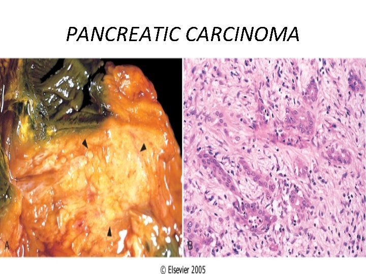 Cancers of the liver and pancreas Cancers of