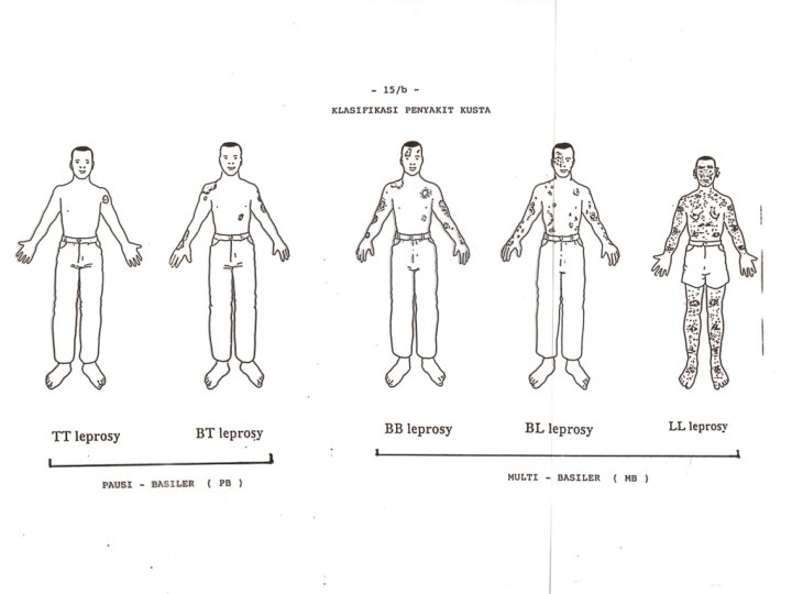 Clinical skill Morbus Hansen GAMBARAN KLINIK DAN KLASIFIKASI