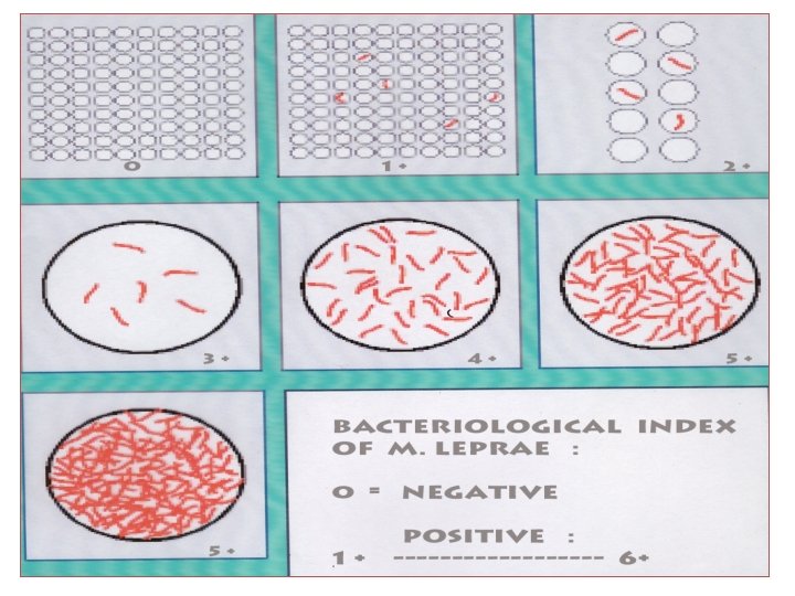 Clinical skill Morbus Hansen GAMBARAN KLINIK DAN KLASIFIKASI