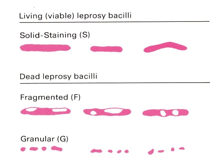 Clinical skill Morbus Hansen GAMBARAN KLINIK DAN KLASIFIKASI
