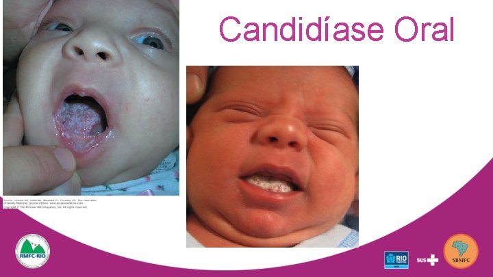 Problemas comuns no 1 ano de vida Nas