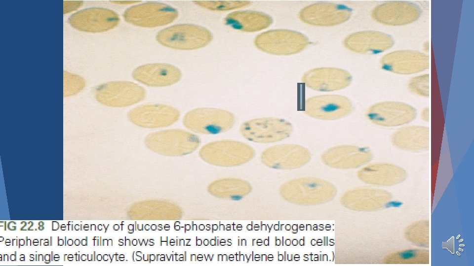 Anemia 1 decreased production of RBCs iron deficiency