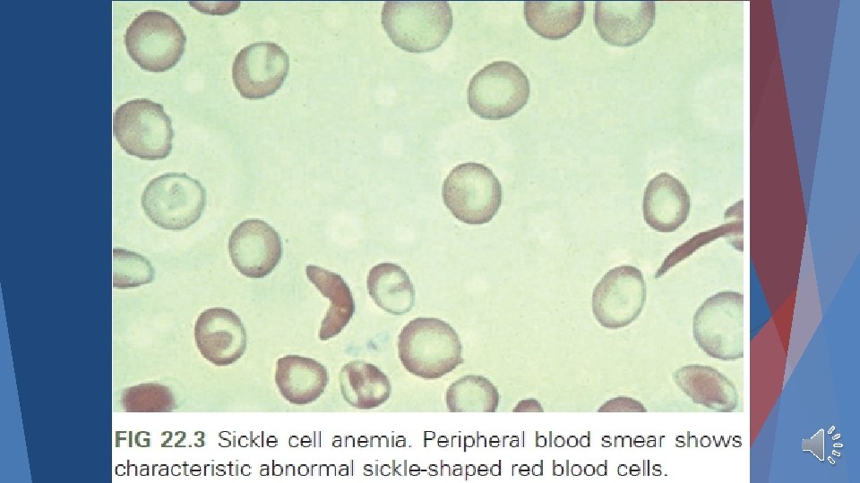 Anemia 1 decreased production of RBCs iron deficiency